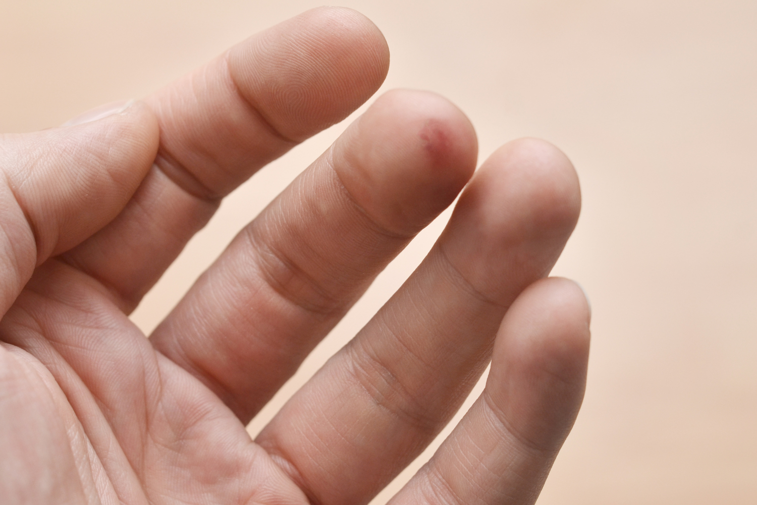 Hoelang duurt een gekneusde vinger? Herstelduur & praktische tips 2026